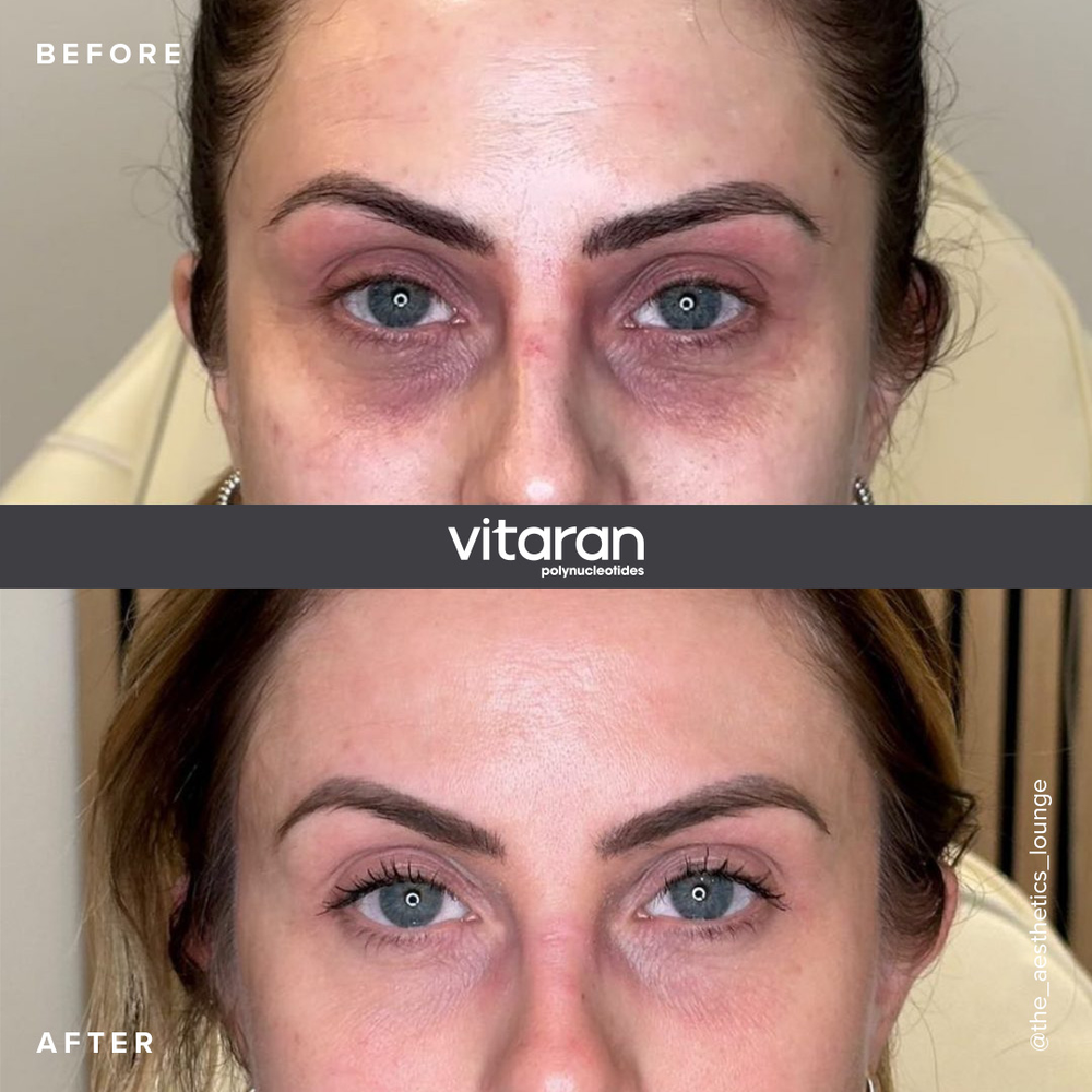 Buy Vitaran Eyes - Advanced Under-Eye Rejuvenation | HUK Aesthetics